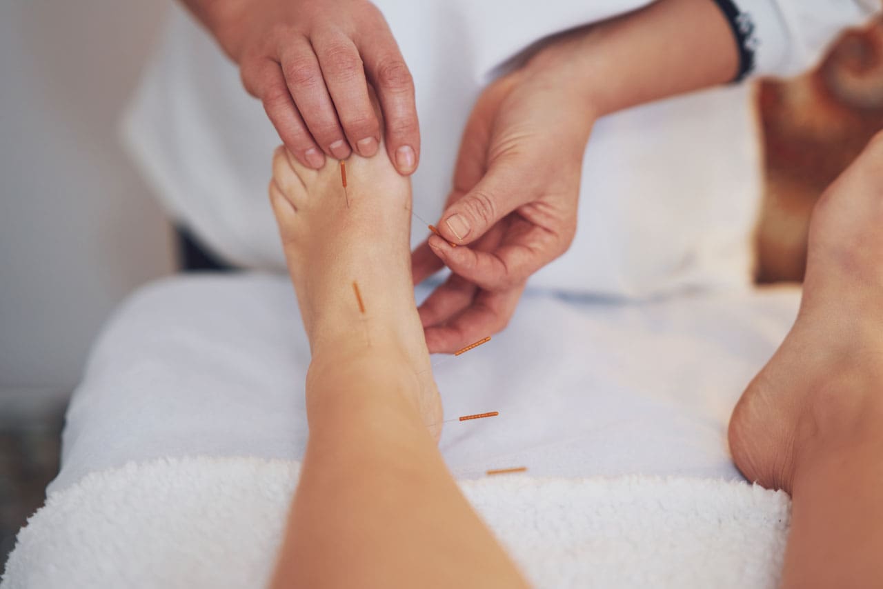 A Guide to Treating Plantar Fasciitis with Acupuncture - Chiropractic ...